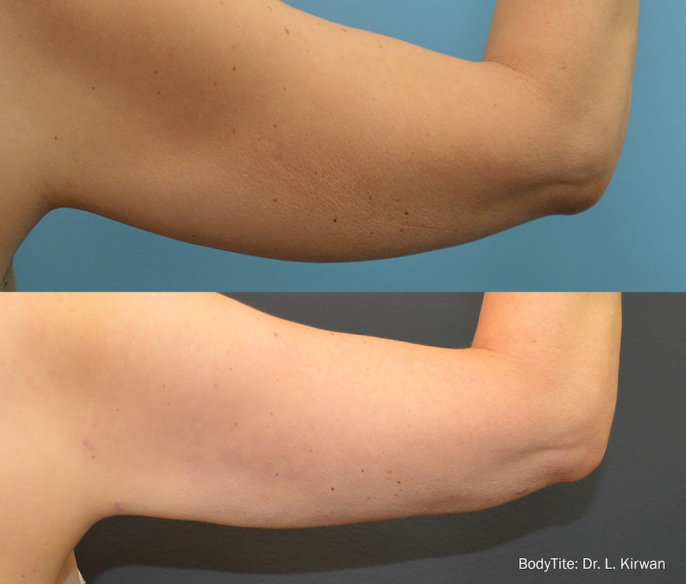 Bodytite with Lipo – Luxe Derm Aesthetics